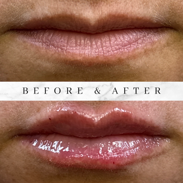 Lip Filler in Lubbock TX - Lip Injections