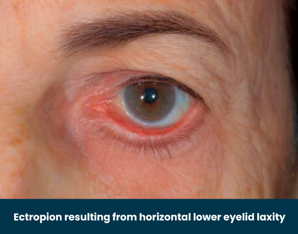 Oculoplastic Surgery in Lubbock, Texas