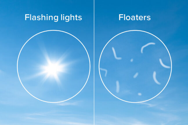 Eye Floaters and Flashes: When to Worry and When It’s Normal