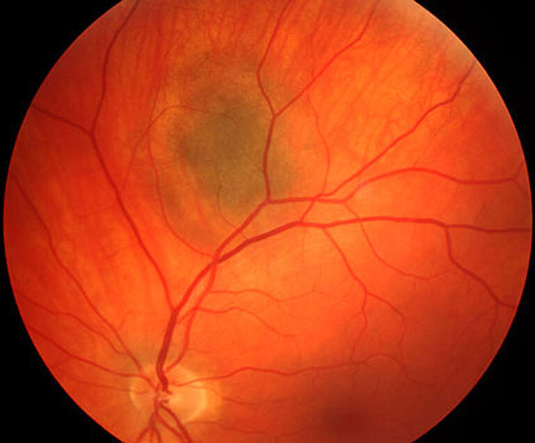 Choroidal Nevus | Signs and Risks at West Texas Eye Associates