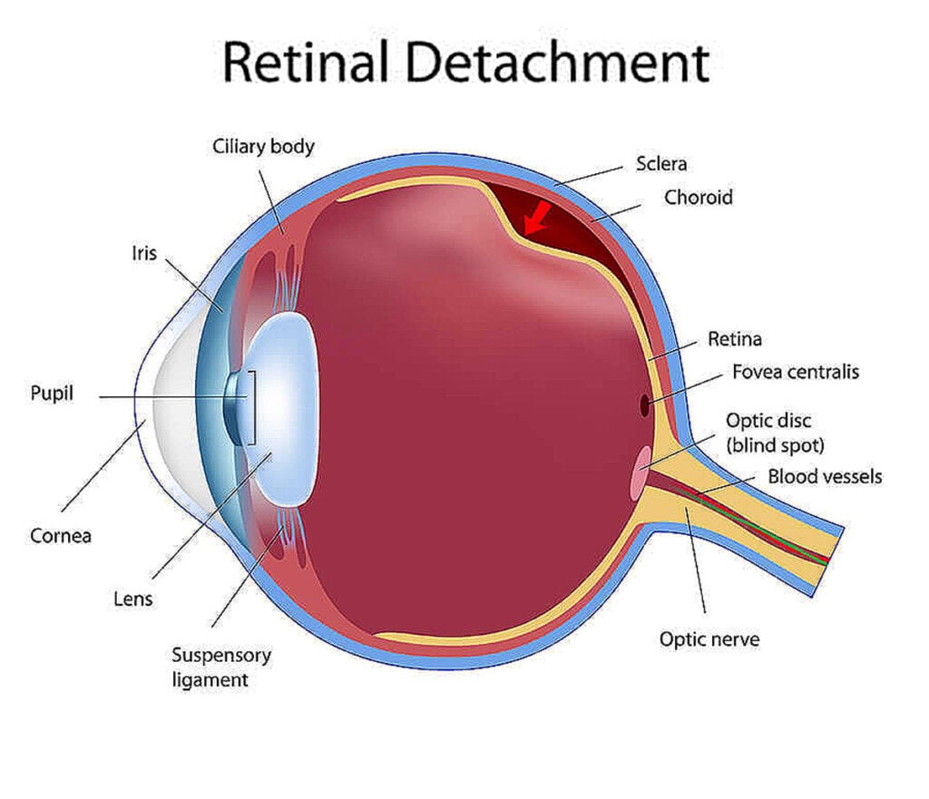 Warning Signs of Retinal Detachment | West Texas Eye Associates