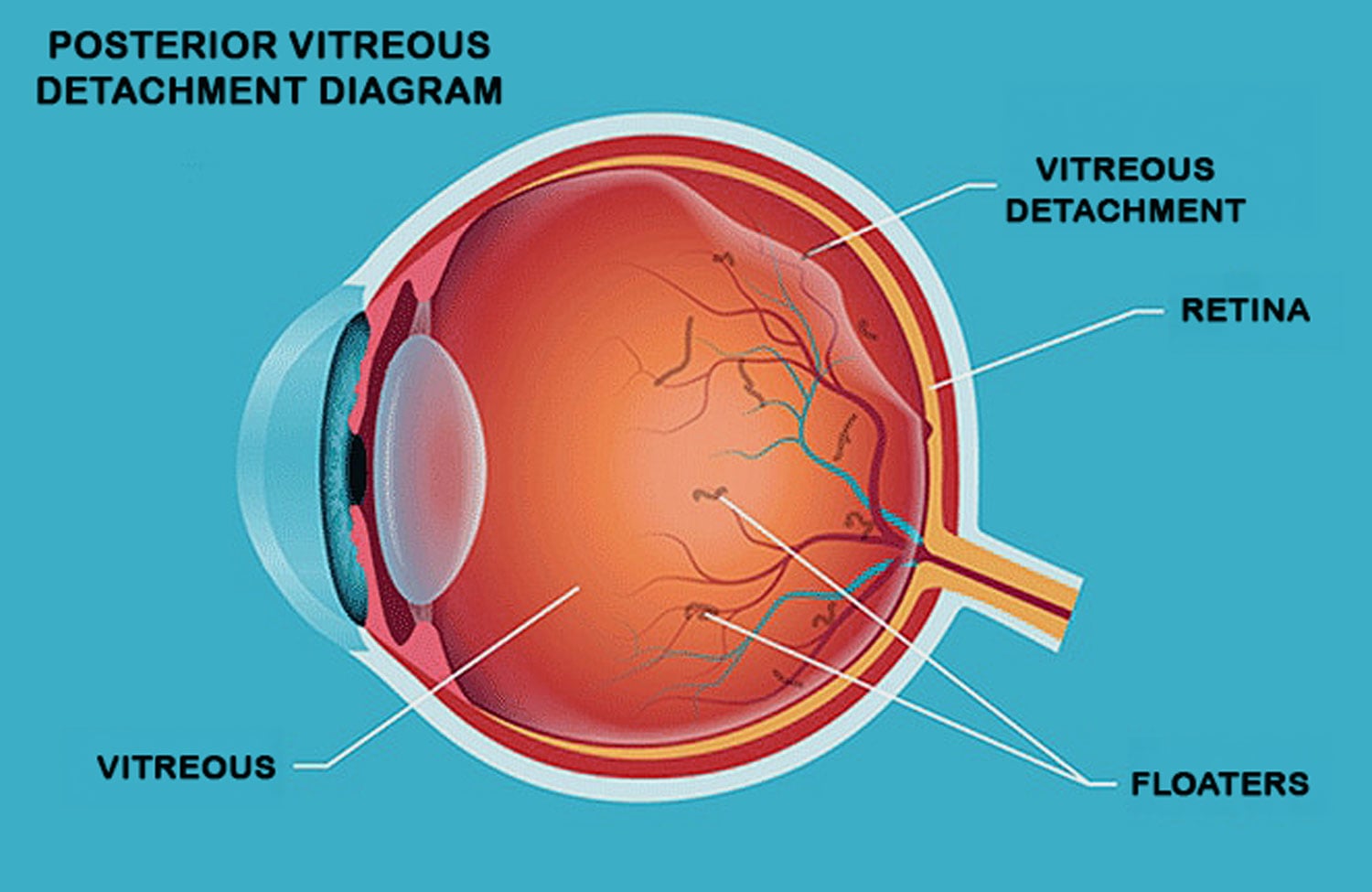 Desprendimiento de vítreo posterior | West Texas Eye Associates