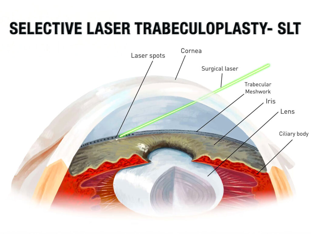Selective Laser Trabeculoplasty (SLT) at West Texas Eye Associates